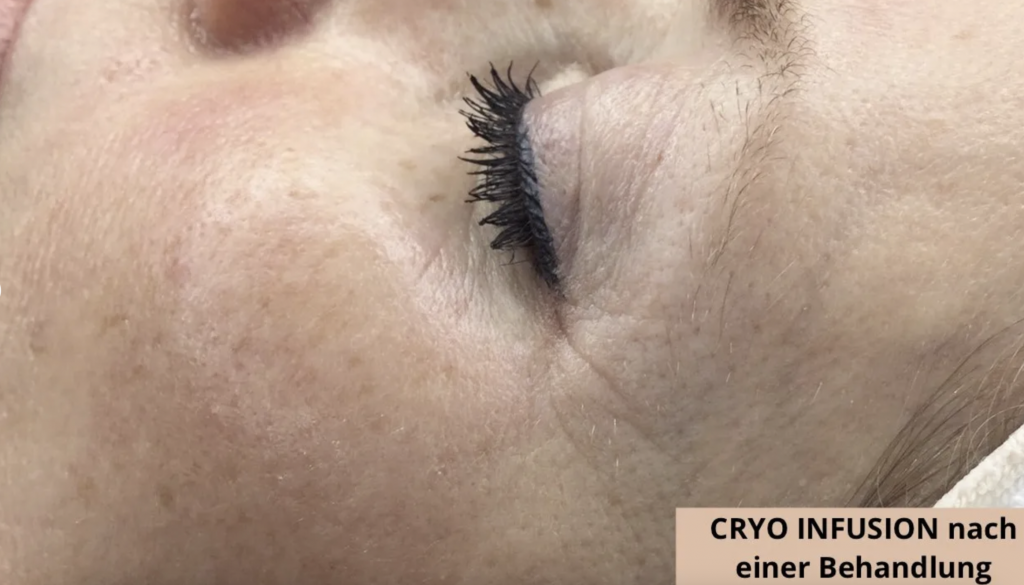 Lymphdrainage Frankfurt - Cryo-Infusion Frankfurt