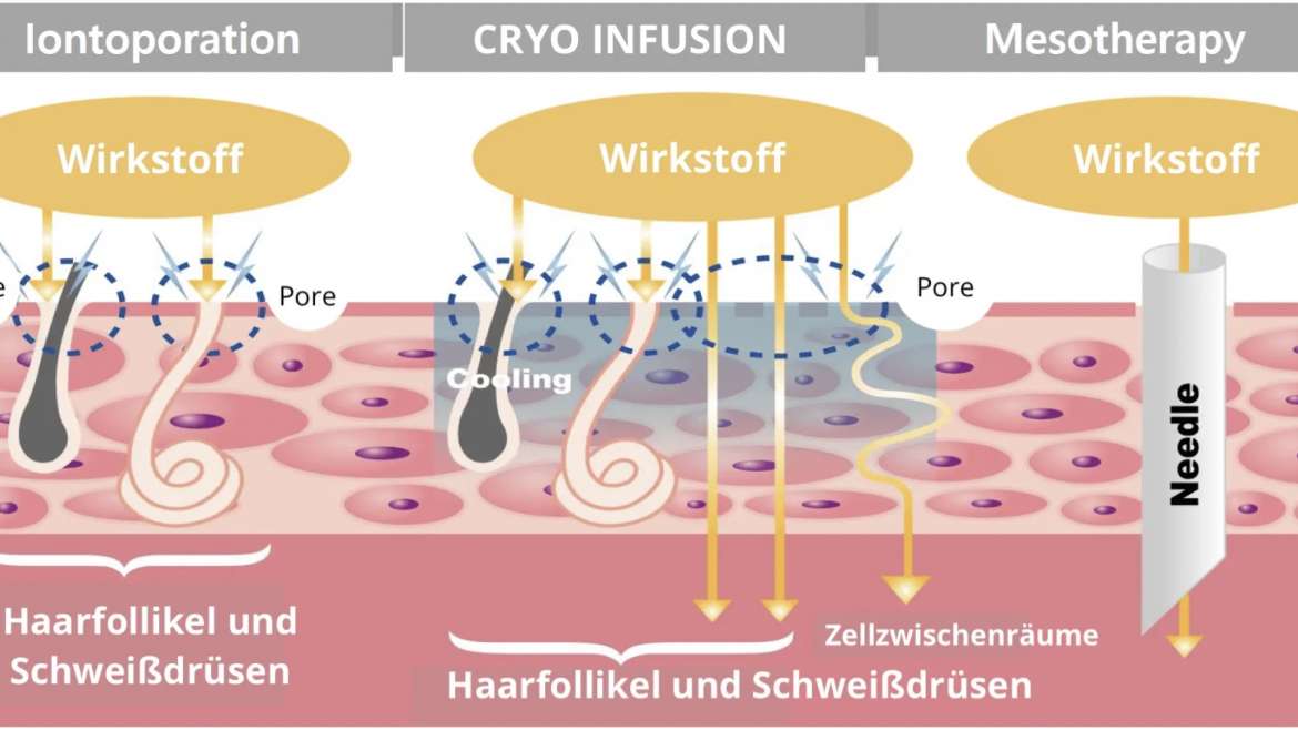Lymphdrainage Frankfurt - Cryo-Infusion Frankfurt